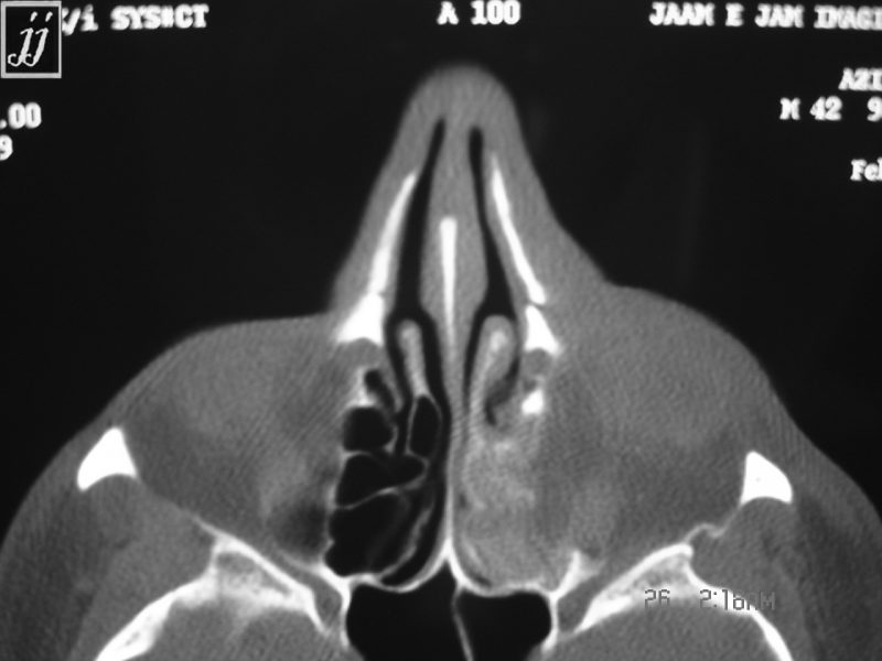 ENT- Left medial blow our fracture ad nasal bone fracture and anterior ...