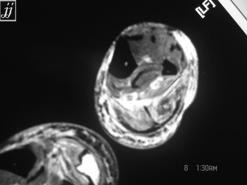 MSK- cyst between gastrocnemius and soleus muscles with abnormal signal ...