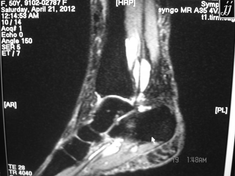 MSK- fluid around posterior tibial tendon vs ganglion cyst (1) - Radioogle