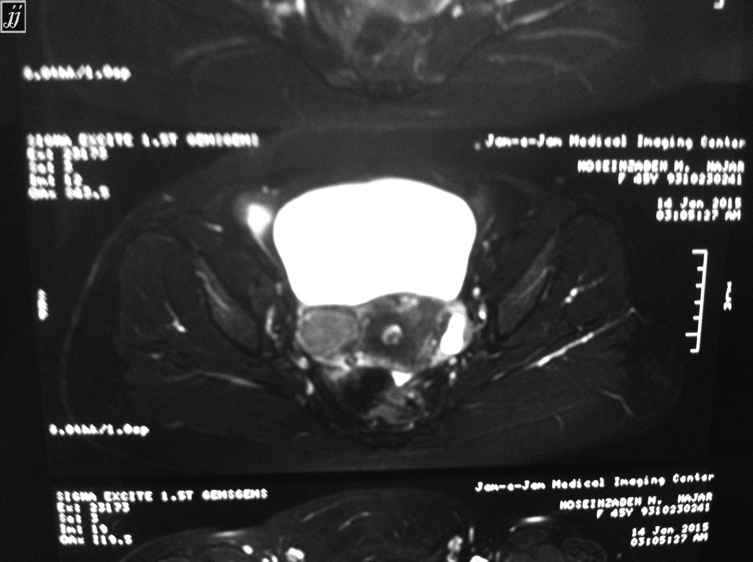 Abdomen- right adnexal cyst and small intramural myoma (6) - Radioogle