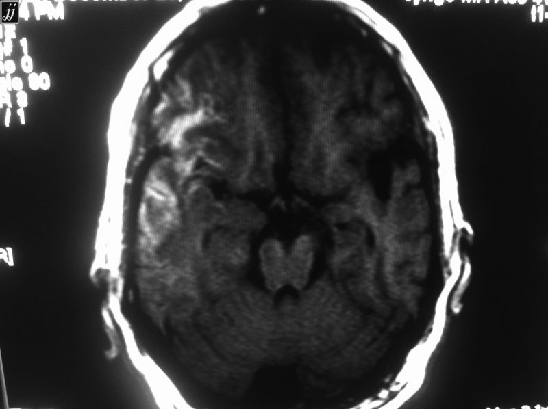 Brain- right subacute hemorrhagic CVA and external capsule hematoma ...