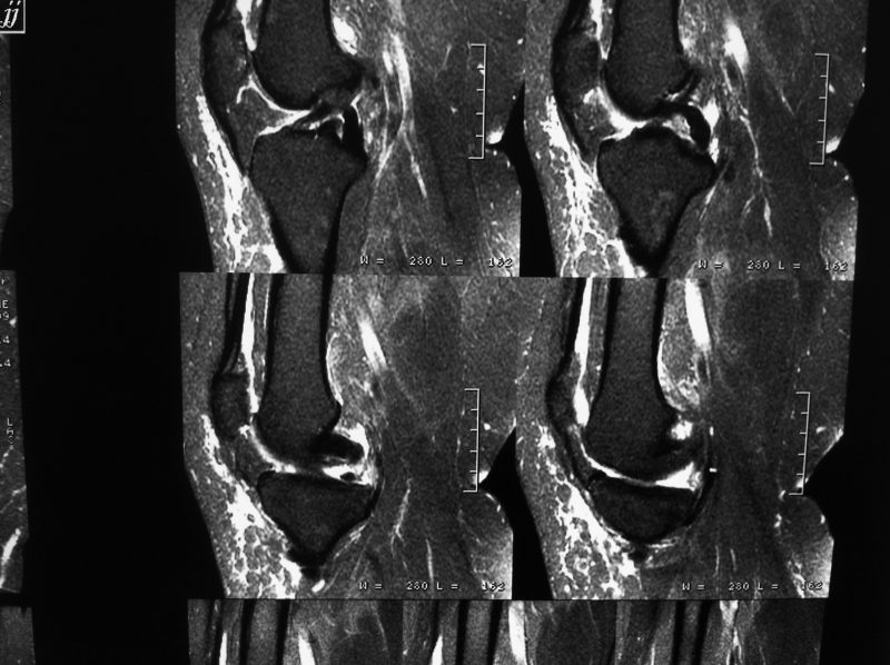 MSK- subcutaneous cellulitis effusion and micro traumatic changes (2 ...