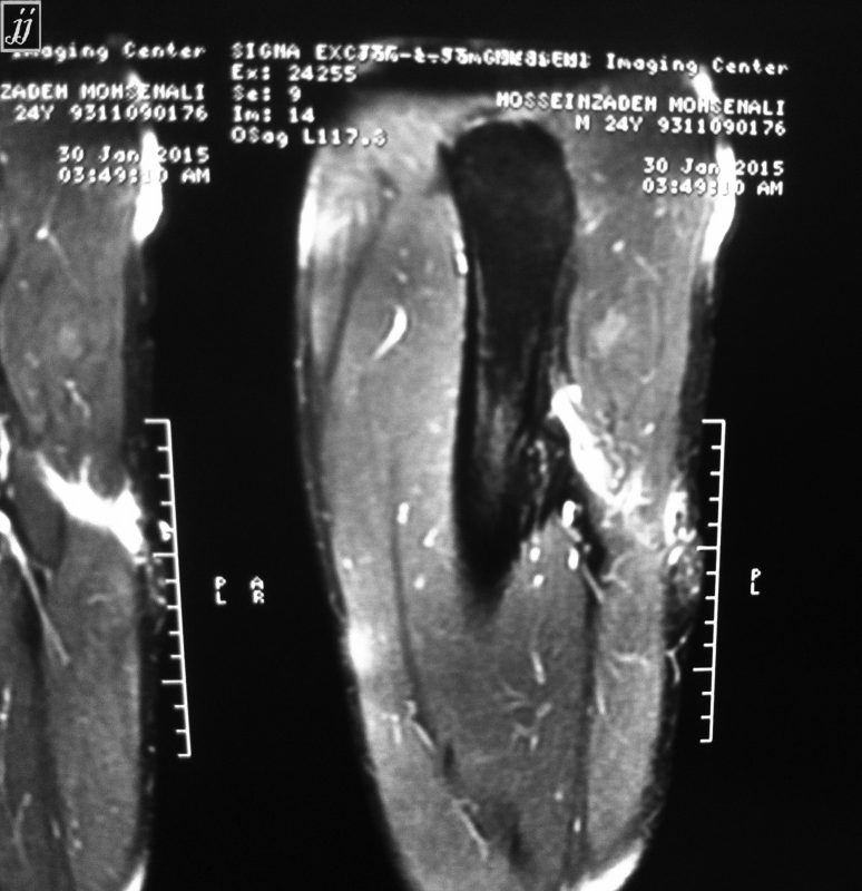 radioogle-msk-posterior-bundle-muscle-post-op-changes-for-a-cortical