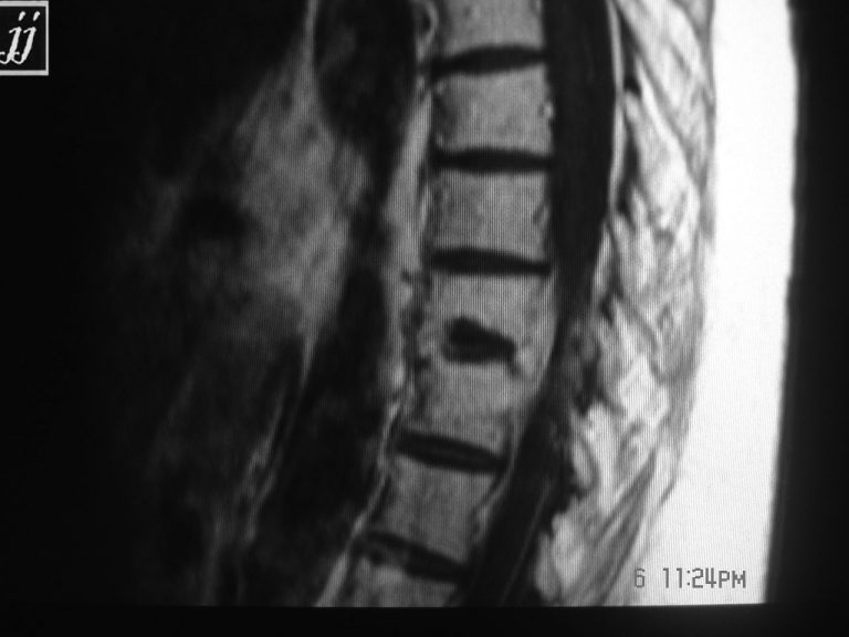 Spine- Atrophic para spinal muscle and replacement by fat and dorsal ...