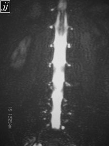 Spine- lateral perineural cyst, meningocele - Radioogle