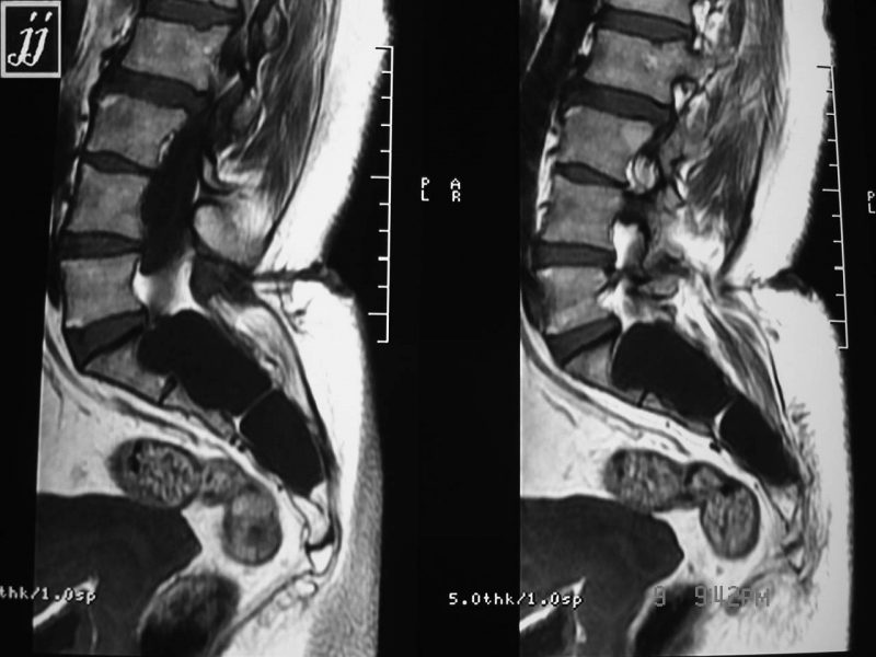 Spine- Huge sized Intrasacral meningocele or perineural cyst as a ...