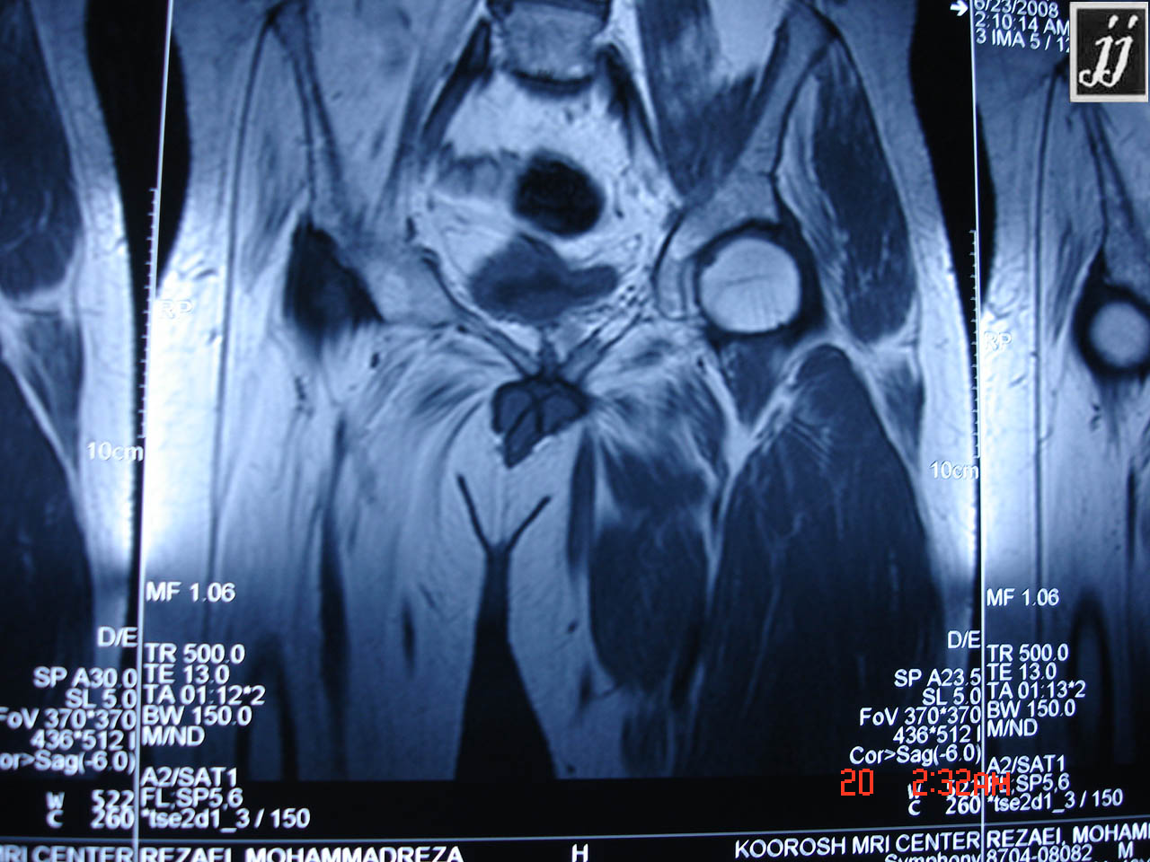 Abdomen- right pelvis and proximal tight muscular atrophy and ...