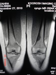 MSK- distal femoral cortical defect or non-ossifying fibroma and ...