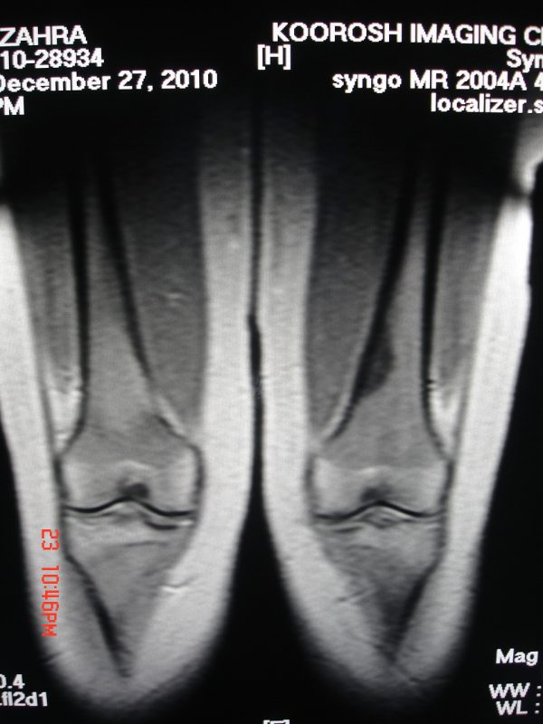 MSK- distal femoral cortical defect or non-ossifying fibroma and ...
