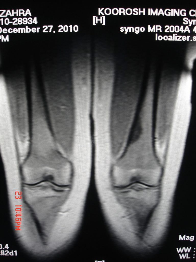 MSK- distal femoral cortical defect or non-ossifying fibroma and ...