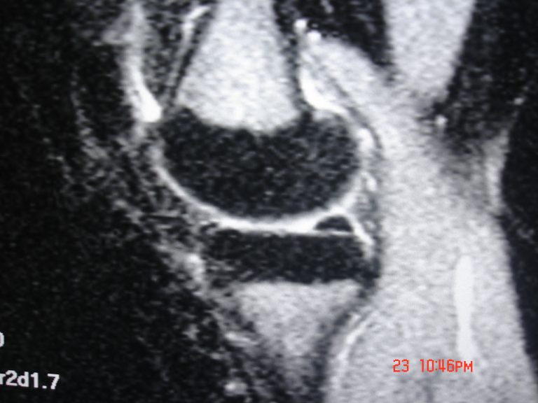 MSK- distal femoral cortical defect or non-ossifying fibroma and ...