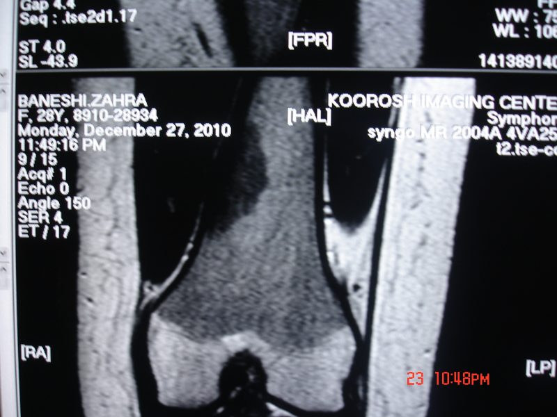 MSK- distal femoral cortical defect or non-ossifying fibroma and ...