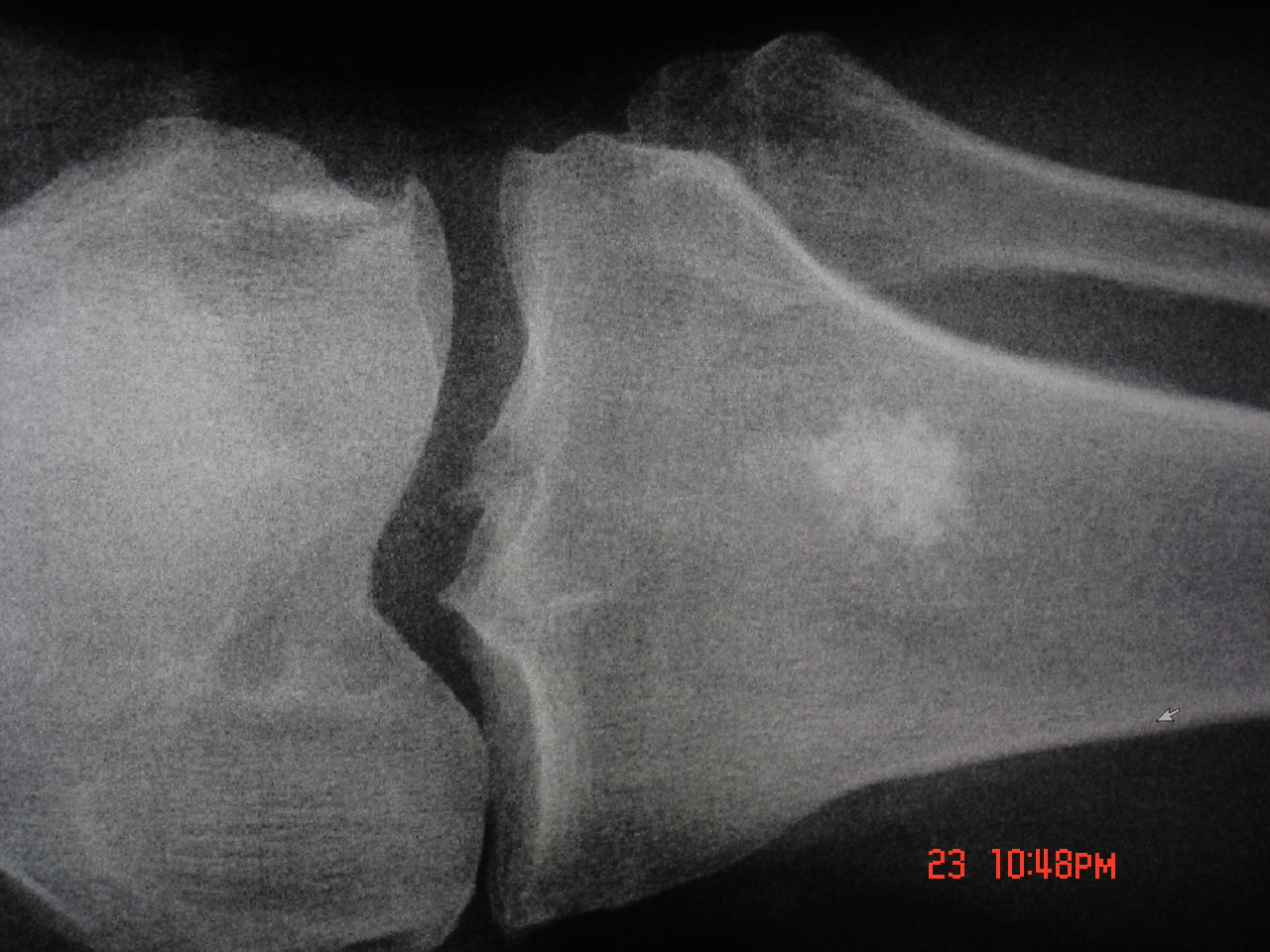 Msk Distal Femoral Cortical Defect Or Non Ossifying Fibroma And Proximal Tibial Sclerosis 9
