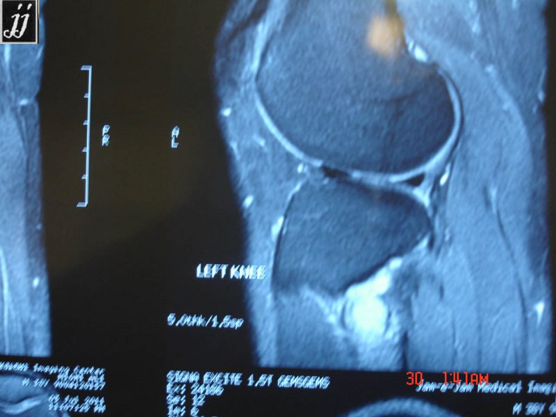 MSK- lateral menisci ganglion cyst- and tibia fibular bursitis (4 ...