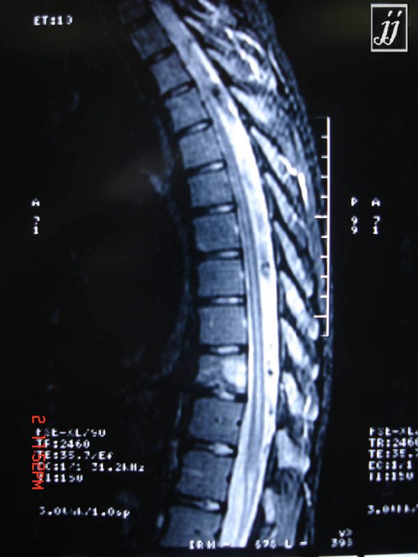Radioogle | Spine- collapsed dorsal vertebral body with abnormal cyst (4)
