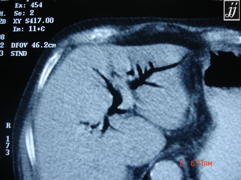 Abdomen- aerobilia - Radioogle