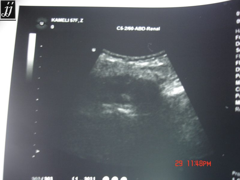 Abdomen- liver multiple cyst or carolis disease (1) - Radioogle