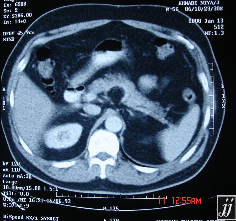 Abdomen- normal pancreas - Radioogle