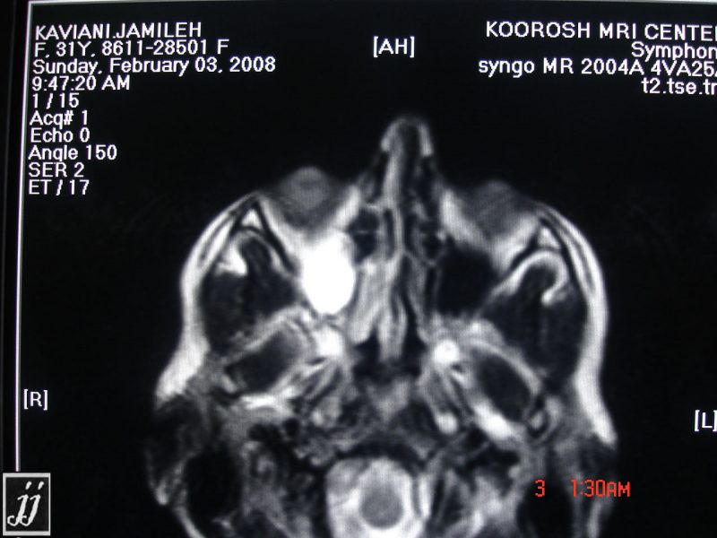 Brain- maxillary sinus retention cyst (3) - Radioogle