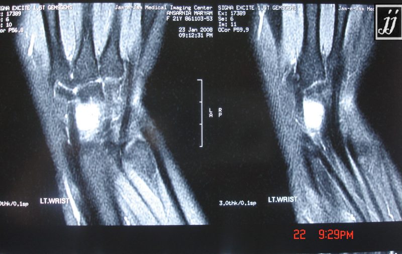 Radioogle | MSK- distal forearm synovial cyst from wrist (2)