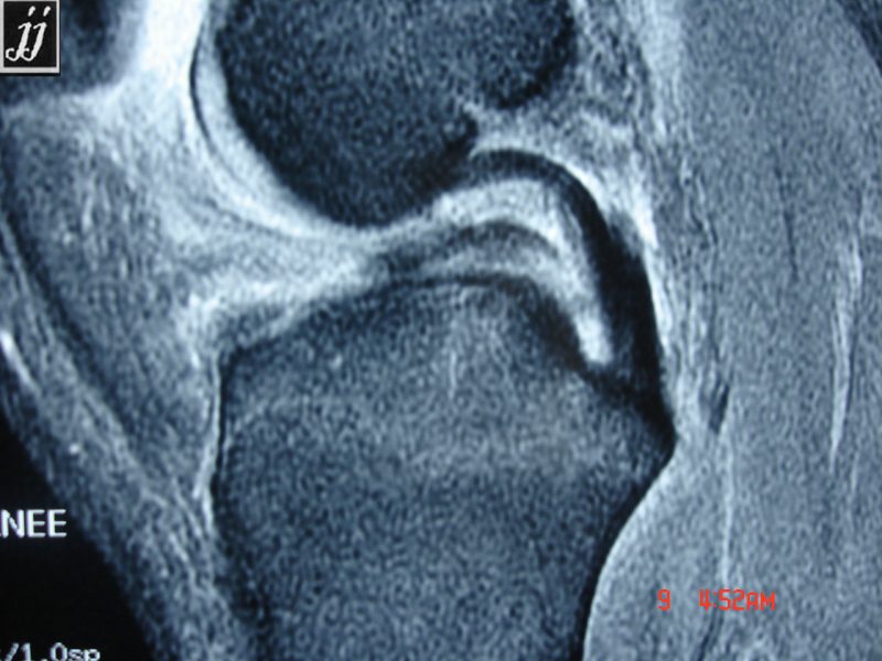 MSK- double posterior cruciate sign due to bucket handle tearing of ...