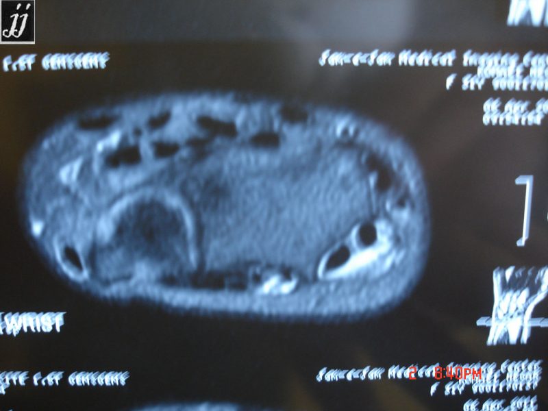 MSK- edema around thumb finger extensor tendon and metacarpo falengian ...