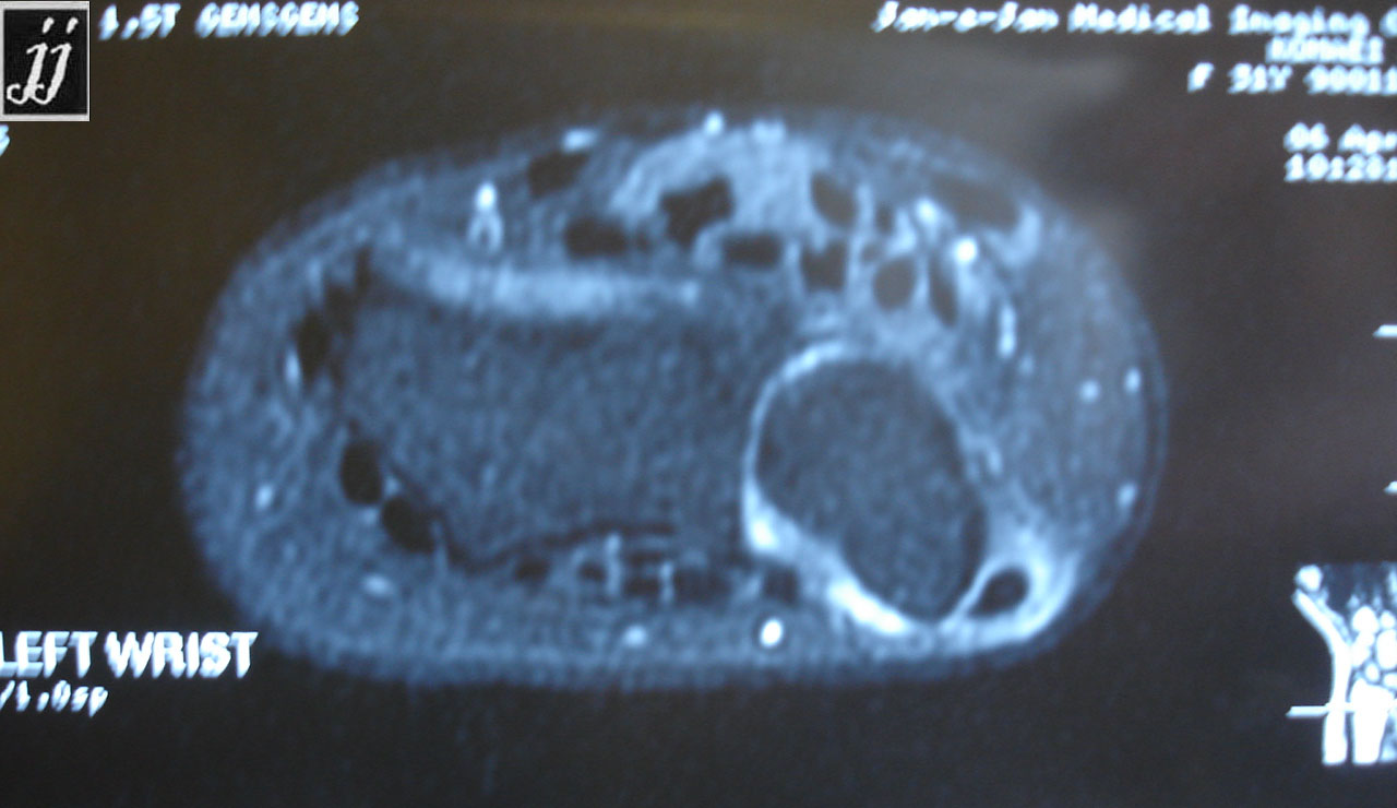MSK- edema around thumb finger extensor tendon and metacarpo falengian ...