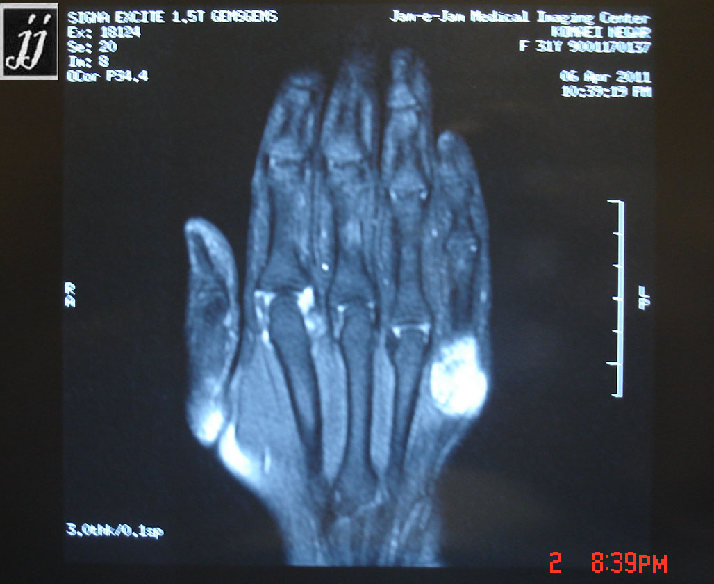 MSK- edema around thumb finger extensor tendon and metacarpo falengian ...