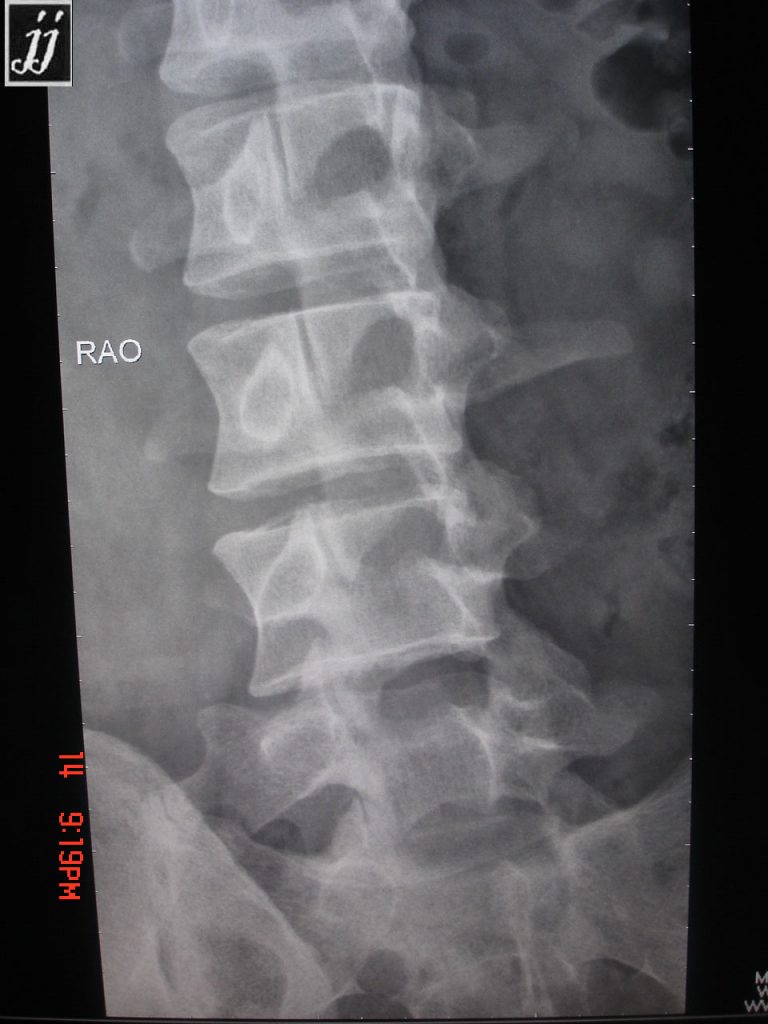 Spine- normal scotty dog (1) - Radioogle