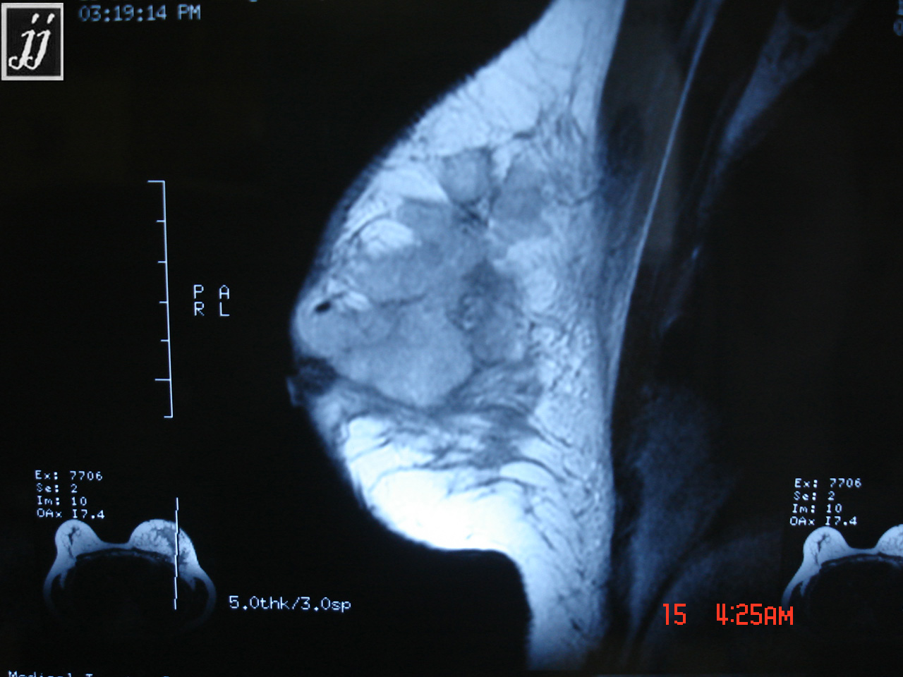 Breast- mastitis and abscess (1) - Radioogle