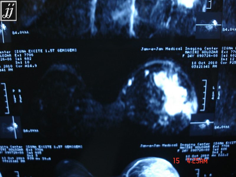 Breast- mastitis and abscess (7) - Radioogle