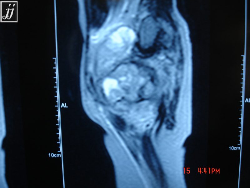 MSK- Spindle cell sarcoma of proximal thigh (7) - Radioogle