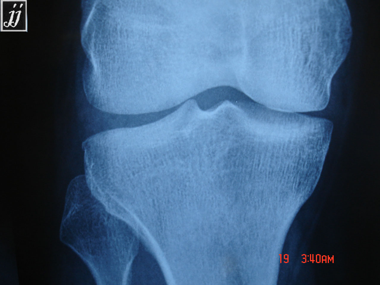 MSK- lateral tibial plateau fracture demonstrated by only MRI (2 ...