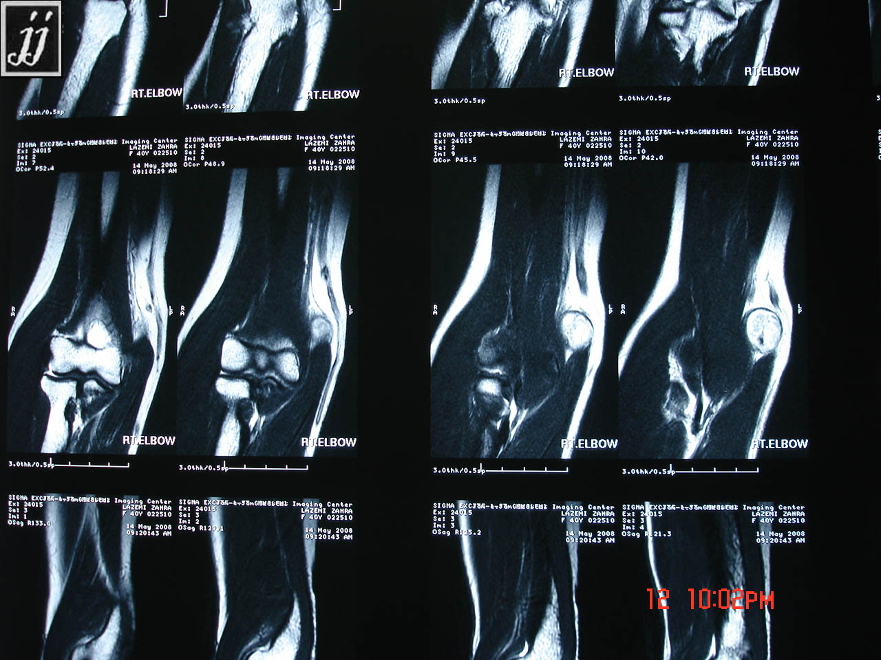 MSK- anterior medial soft tissue of elbow (6) - Radioogle