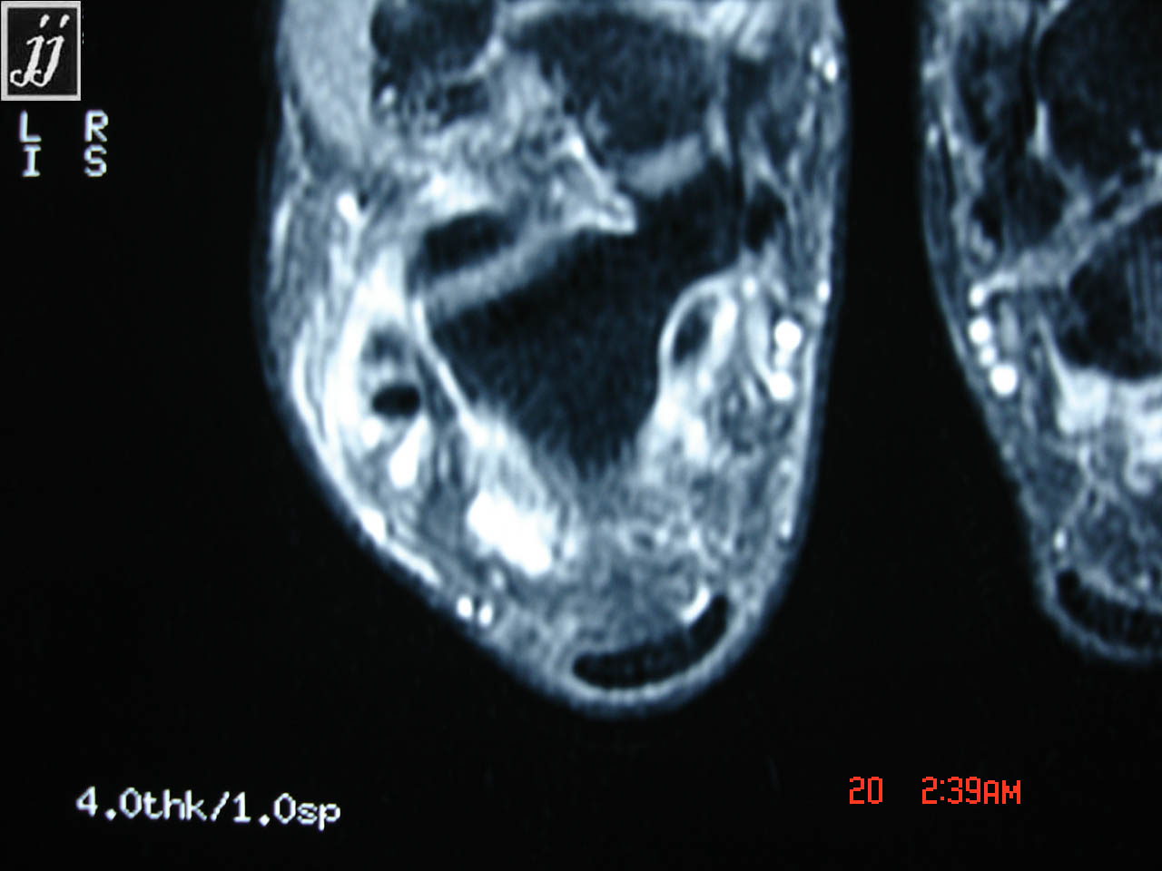 MSK- loose body in the sheet of hallucis longus and hallucis brevis ...