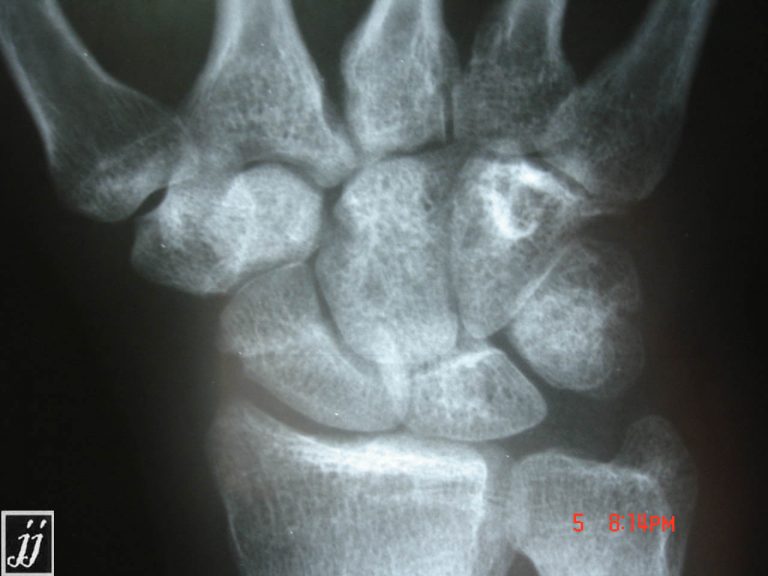 MSK- wrist joint effusion, vasculitis and subchondral bone defect as in ...