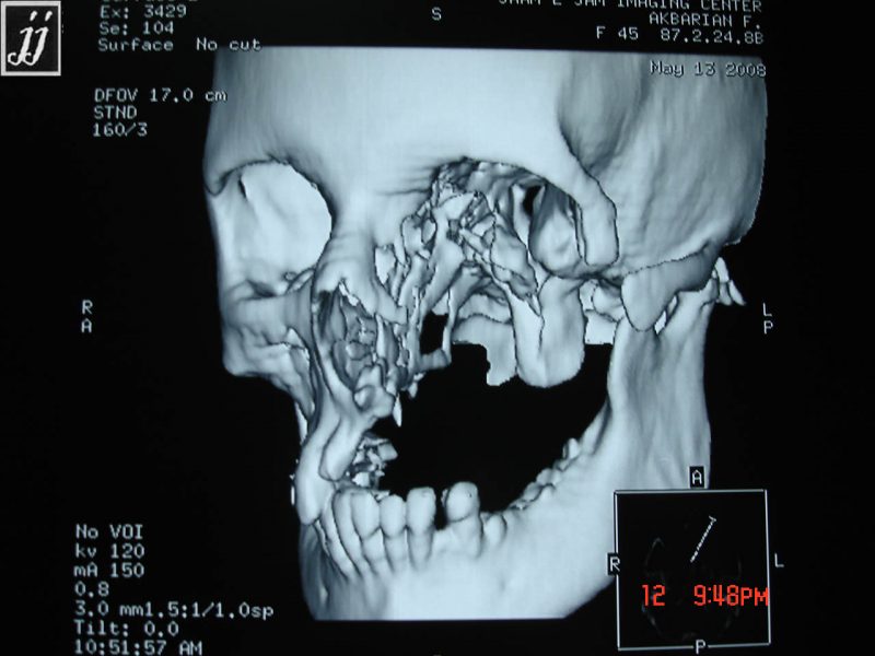 Orbit- nasal cavity tumor, chondroma chondrosarcoma, chordoma (1 ...