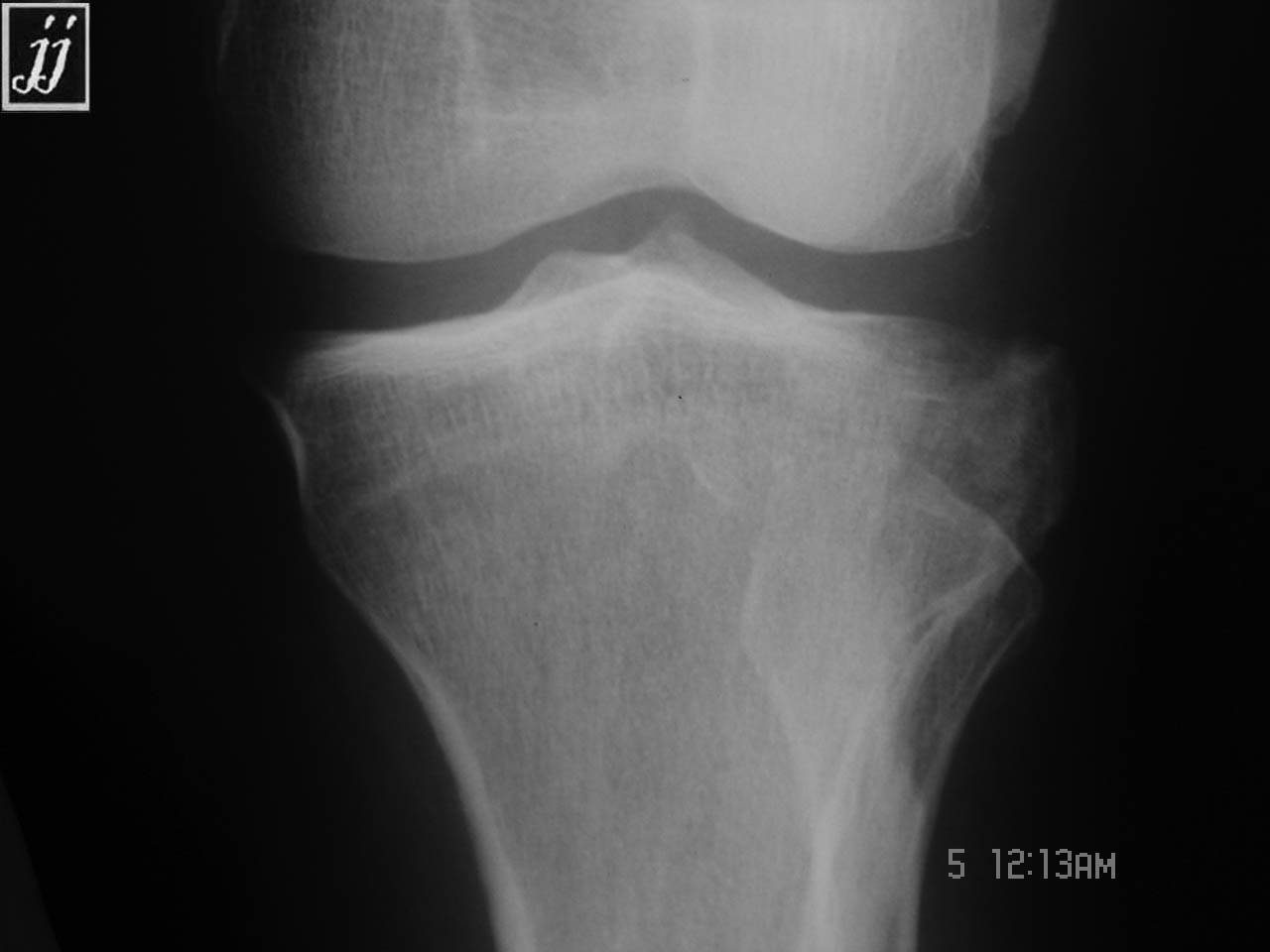 MSK- fat fluid level in supra patella poach, due to lateral tibial ...