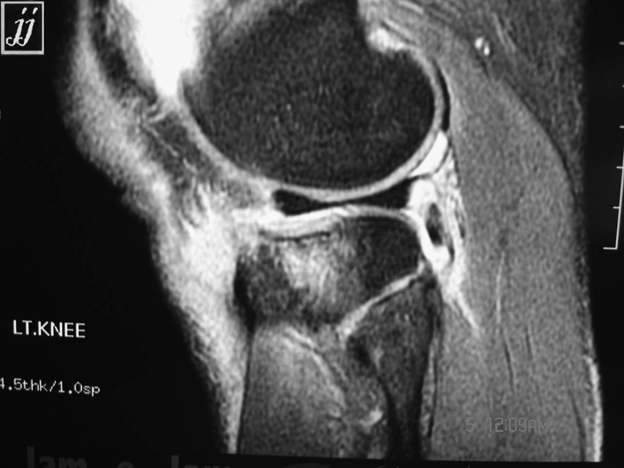 MSK- fat fluid level in supra patella poach, due to lateral tibial ...