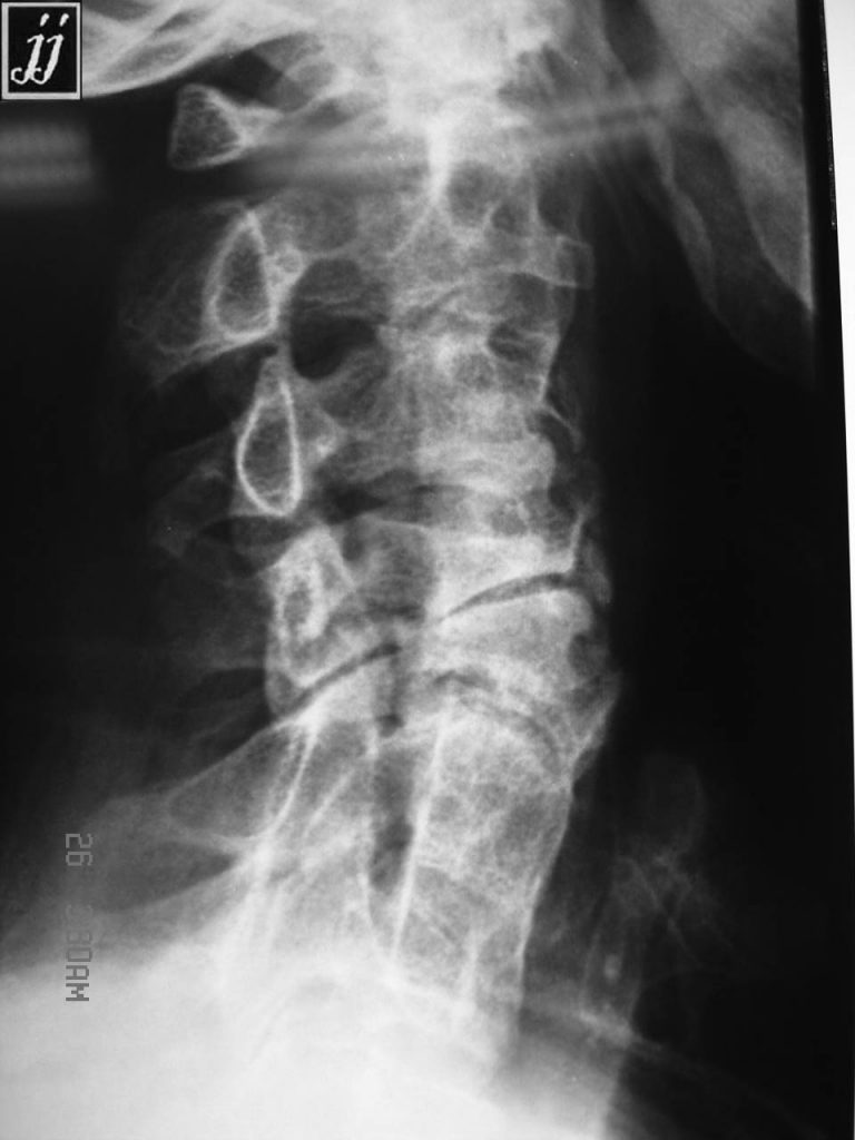Spine- cervical spine vertebral anomalies as hemi vertebral and butter ...