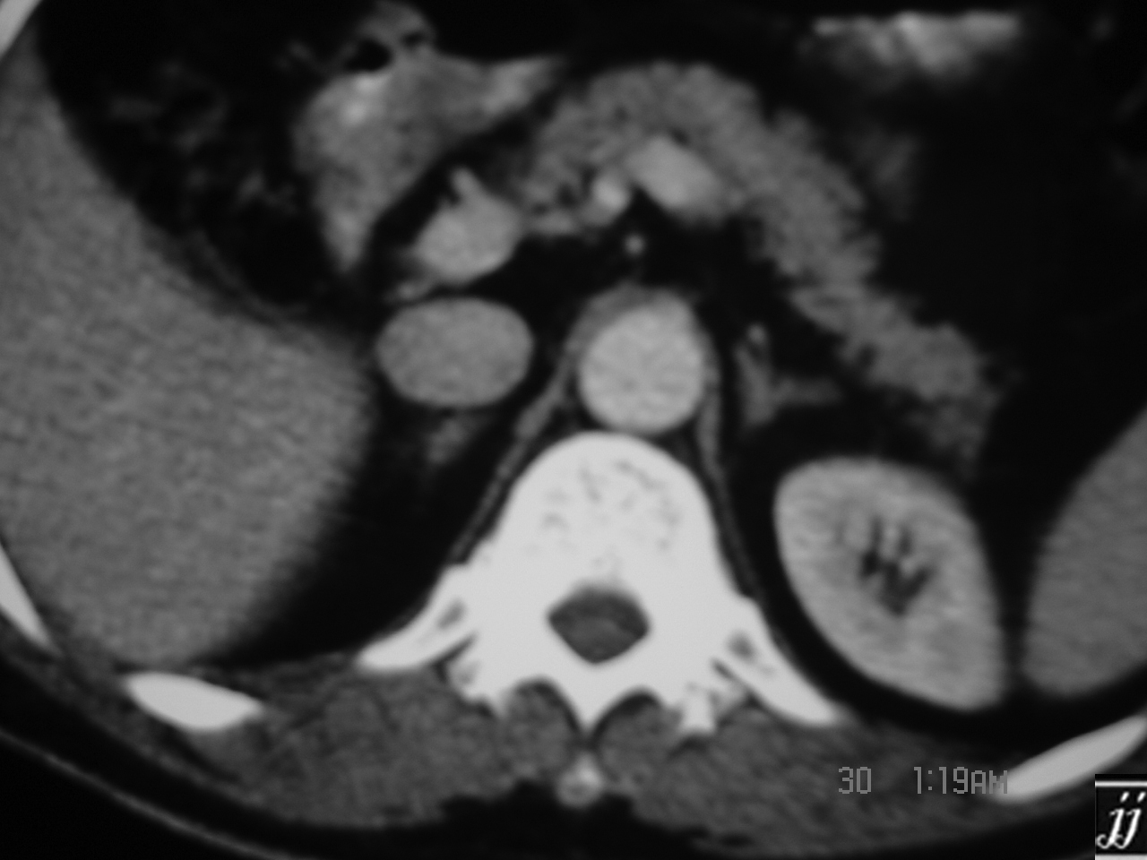 Abdomen- normal anatomy (3) - Radioogle