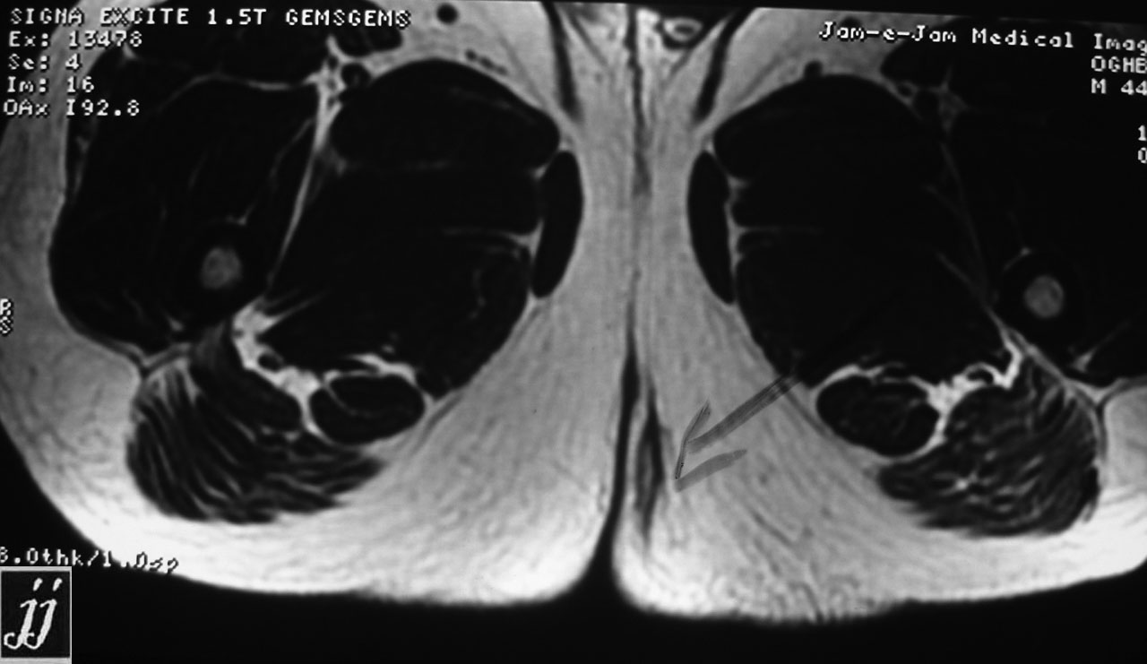 Abdomen- left perineal fistula and sinus tract (3) - Radioogle