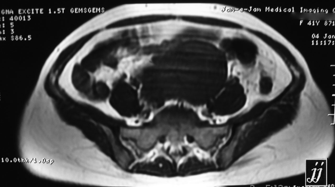 Abdomen- Intramural myomatous uterus (2) - Radioogle