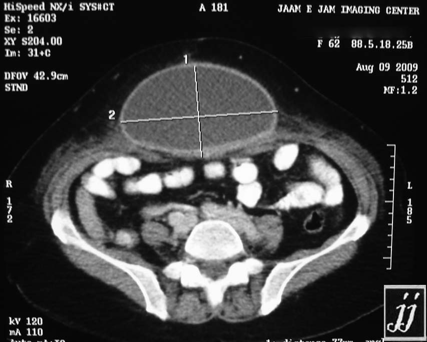 Abdomen- abdominal wall abscess (2) - Radioogle