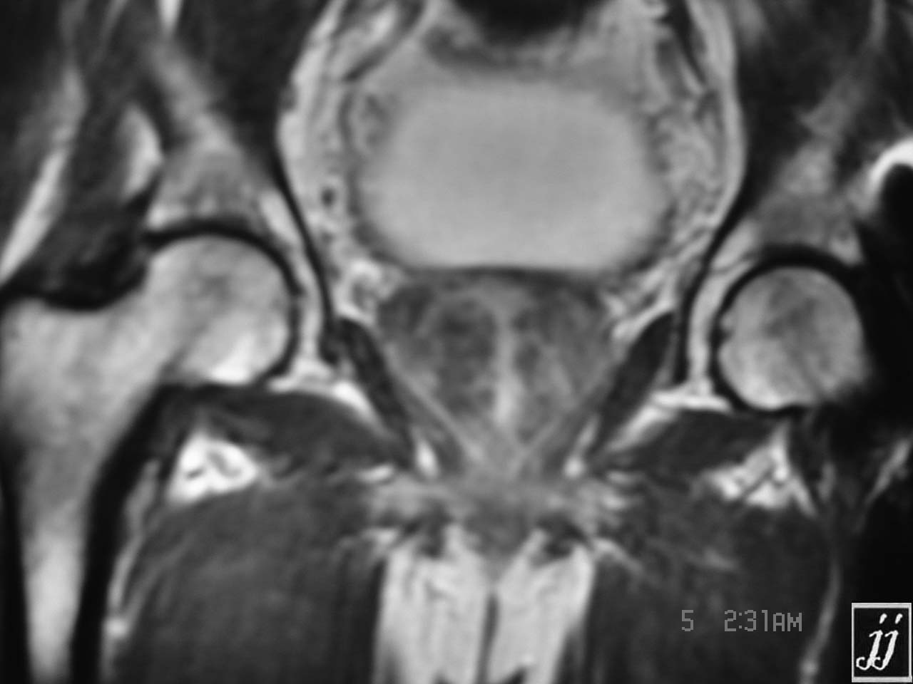 Abdomen- abnormal prostate and right inguinal herniation (15) - Radioogle