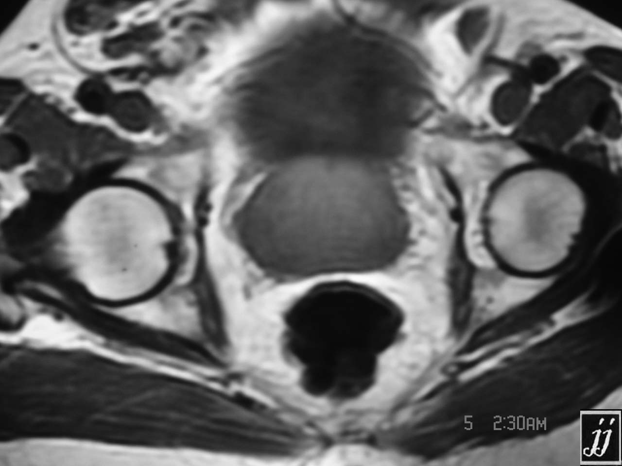 Abdomen- abnormal prostate and right inguinal herniation (9) - Radioogle