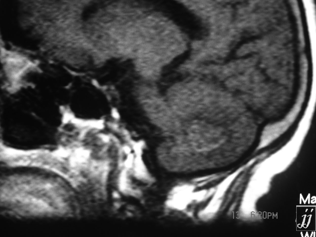 Brain- posterior fossa mass lesion (2) - Radioogle