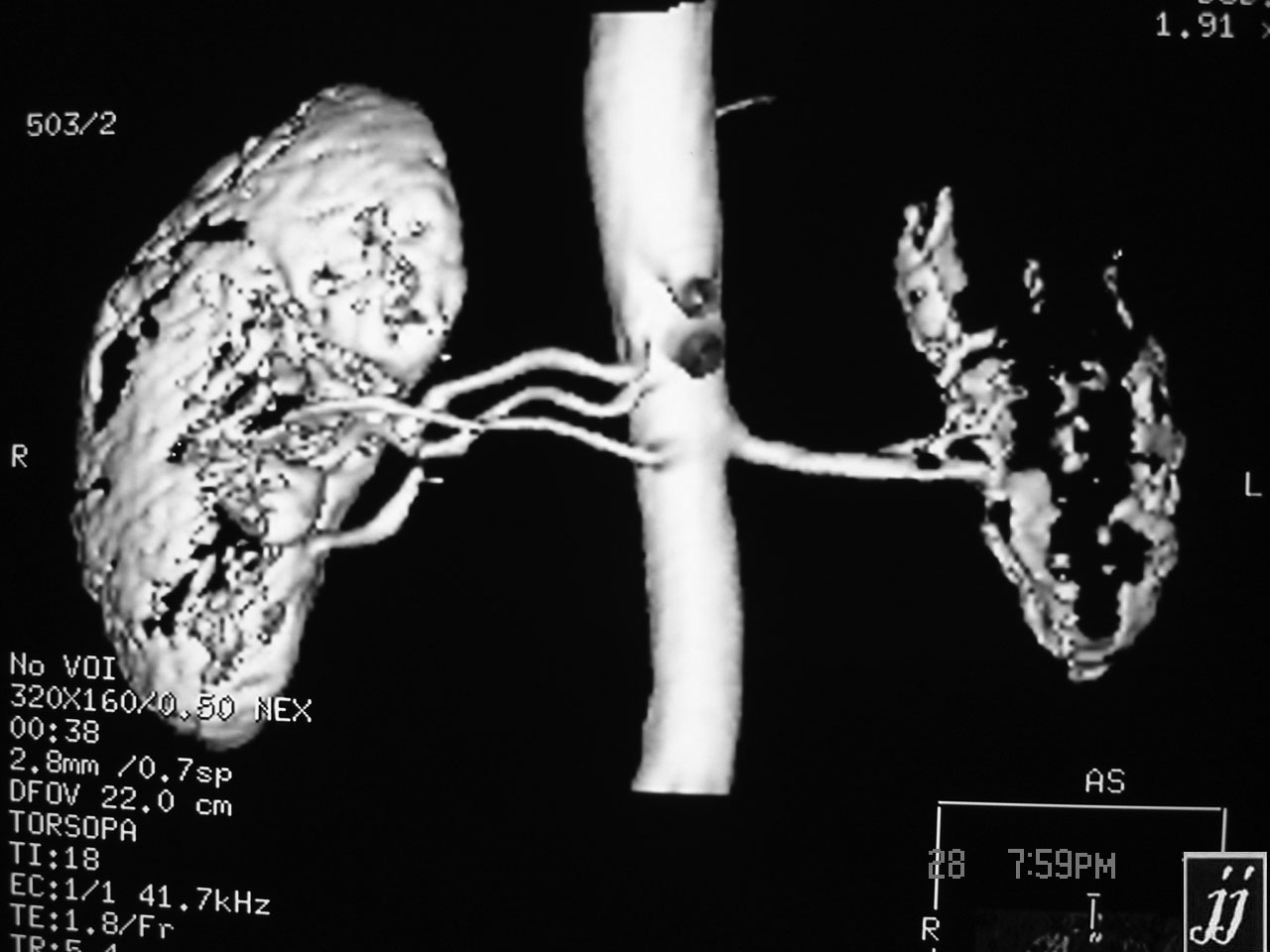 Abdomen- renal MRA, triple artery of right side and stenosis of the ...