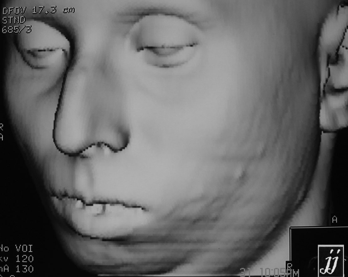 ENT- nasal septal deviation and adenoid tissue and mandibular asymmetry ...