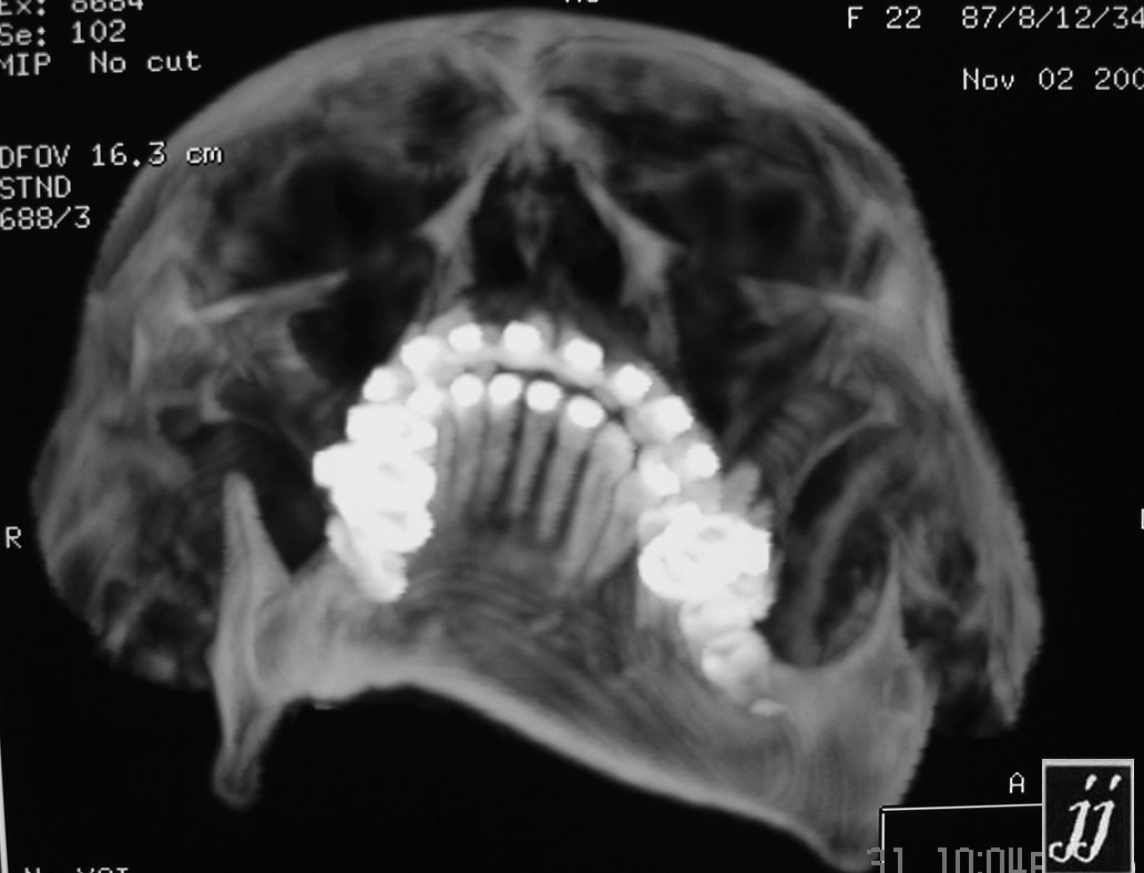 ENT- nasal septal deviation and adenoid tissue and mandibular asymmetry ...